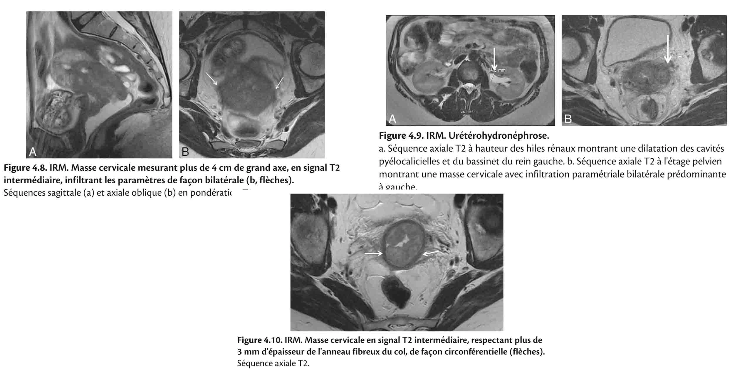 Pathologie du col utérin