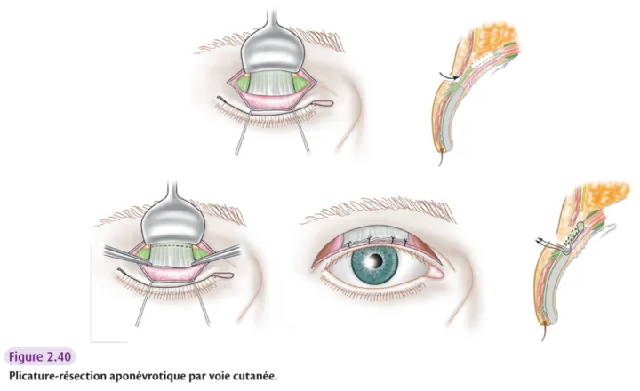 Chirurgie palpébrale : Ptosis