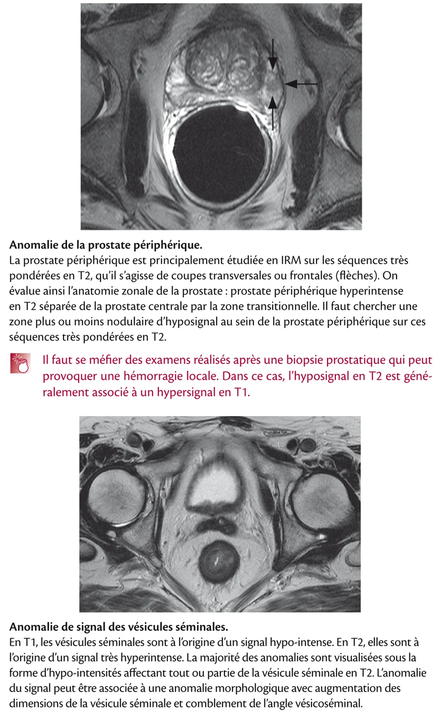 IRM : Cancer de la prostate