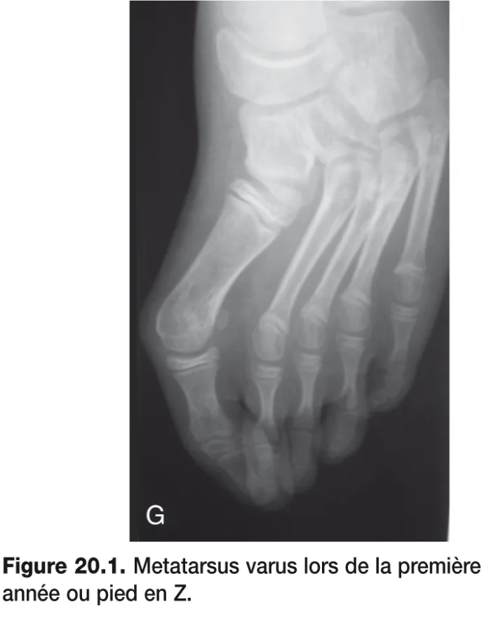 Chirurgie de l’hallux valgus chez l’enfant