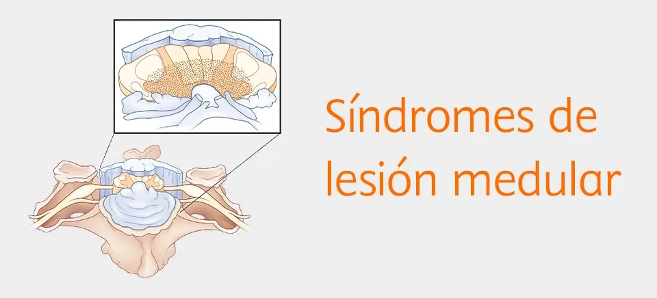 Lesiones Medulares: Patrones y Gravedad.