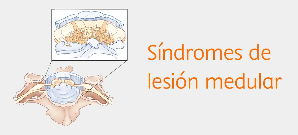 Lesiones Medulares: Patrones y Gravedad.