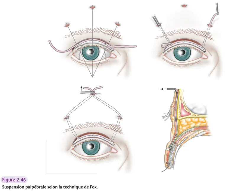 Chirurgie palpébrale : Ptosis