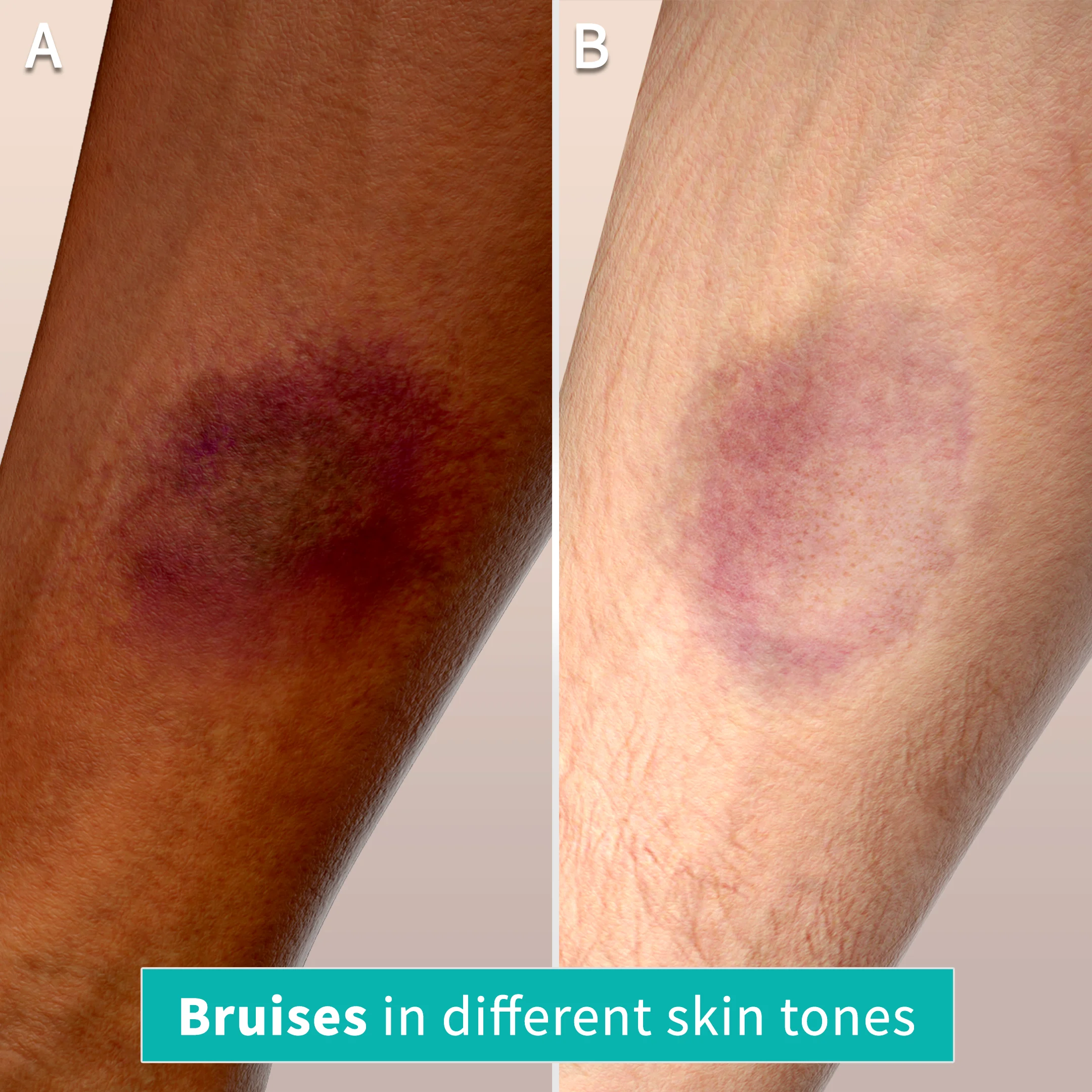 Les manifestations cutanées selon la pigmentation de la peau