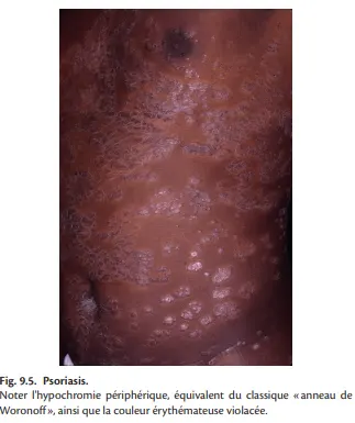 Dermatoses communes