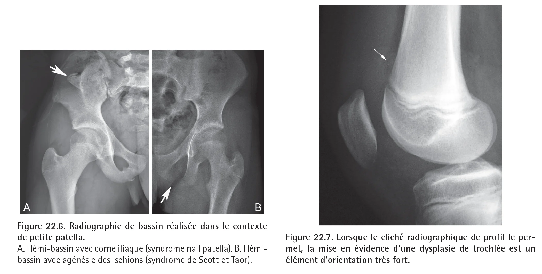 Instabilité Rotulienne chez l'Enfant: Prise en Charge Précoce.