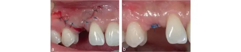 Implants dentaires : précision du positionnement