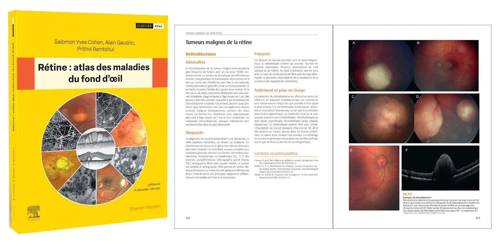 Maladie Rétine De L’Oeil – Problemes Retiniens – ETDKHL