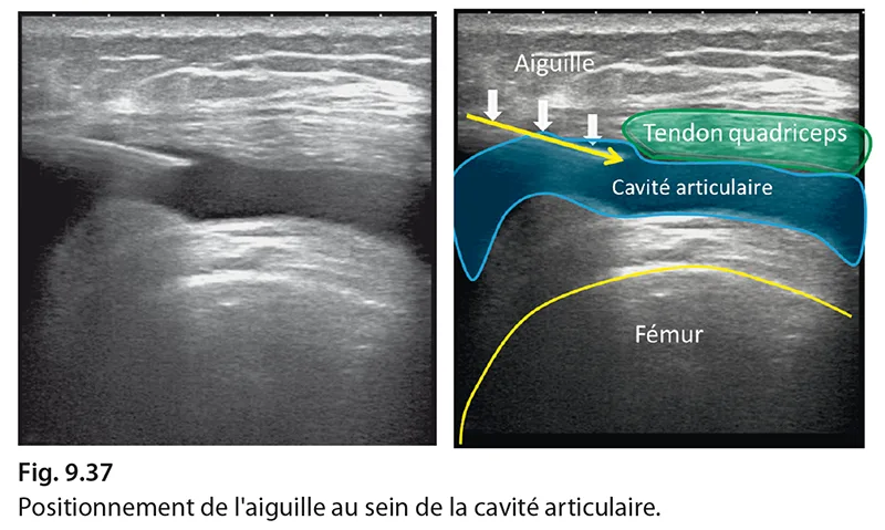 Infiltrations Échoguidées