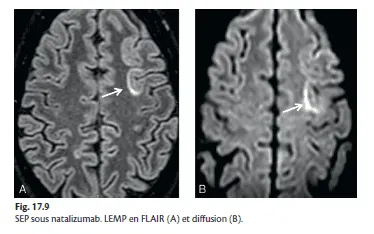 Deuxième cause de handicap de l'adulte jeune après les traumatismes