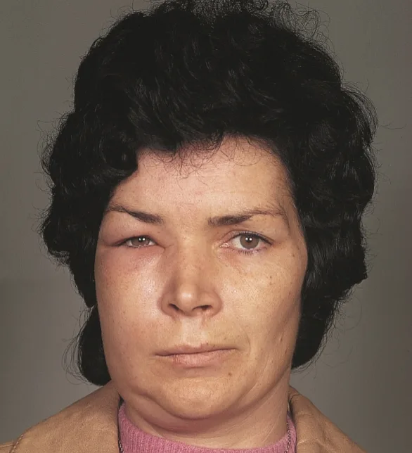 Principales infecciones de la boca y la cara