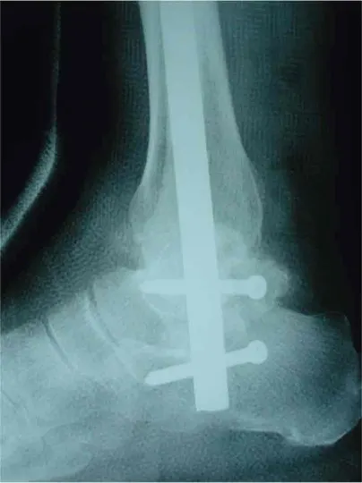 Arthrodèse arthroscopique des articulations tibio-talienne et sous-talienne