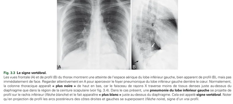 Reconnaître l'anatomie pulmonaire normale