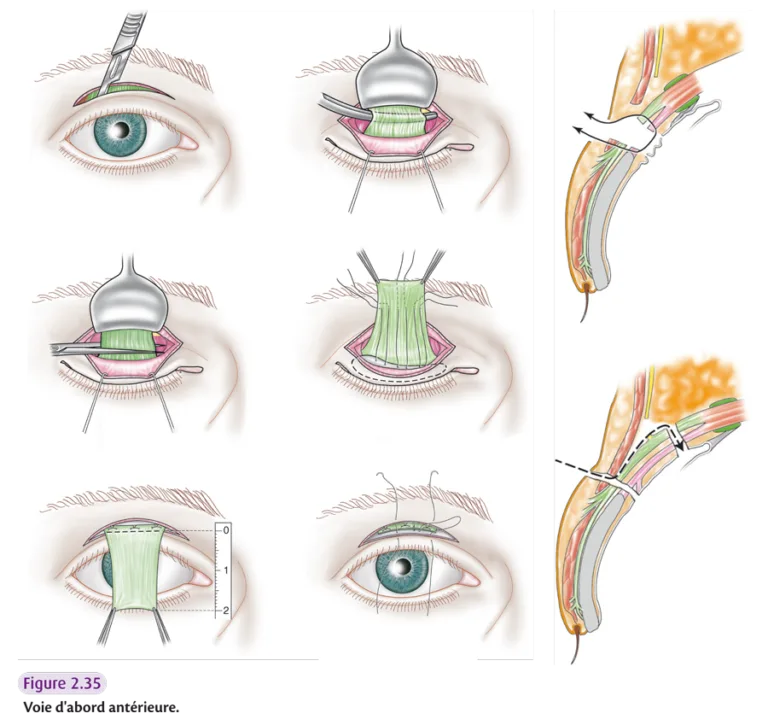 Chirurgie palpébrale : Ptosis