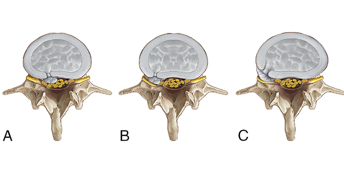 Technique endoscopique hernies discales