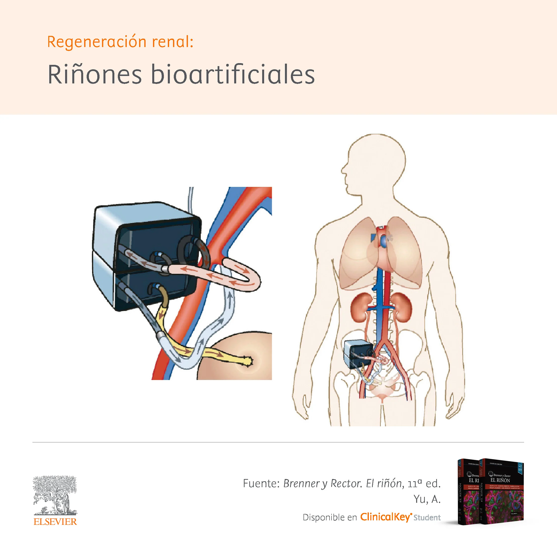 Ingeniería Biomédica Riñones Bioartificiales