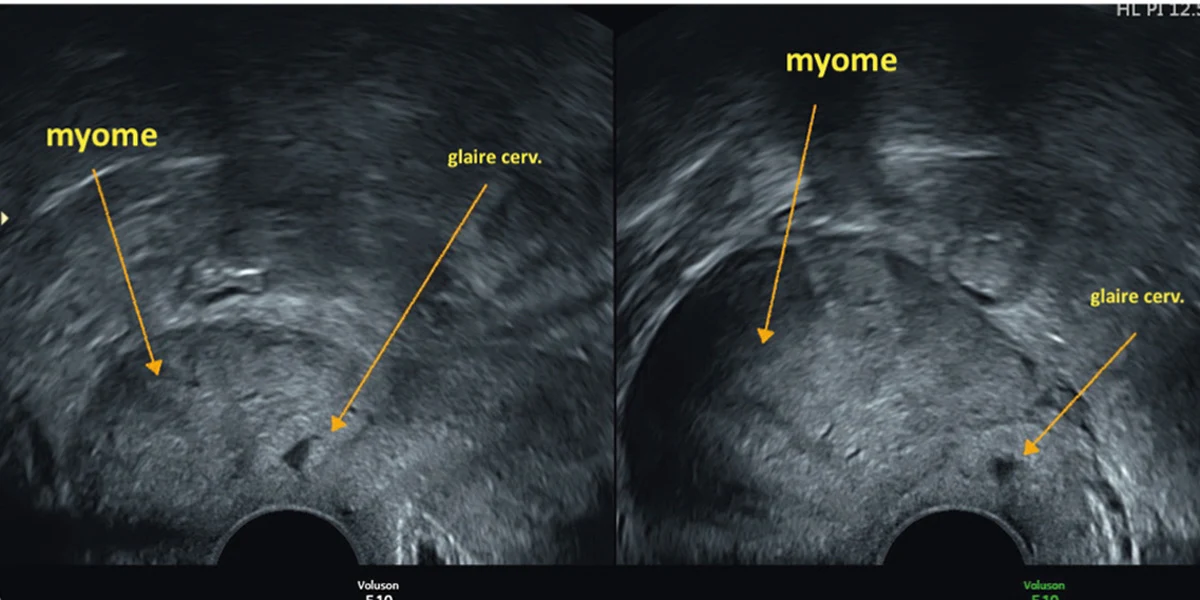 Pathologie du col utérin