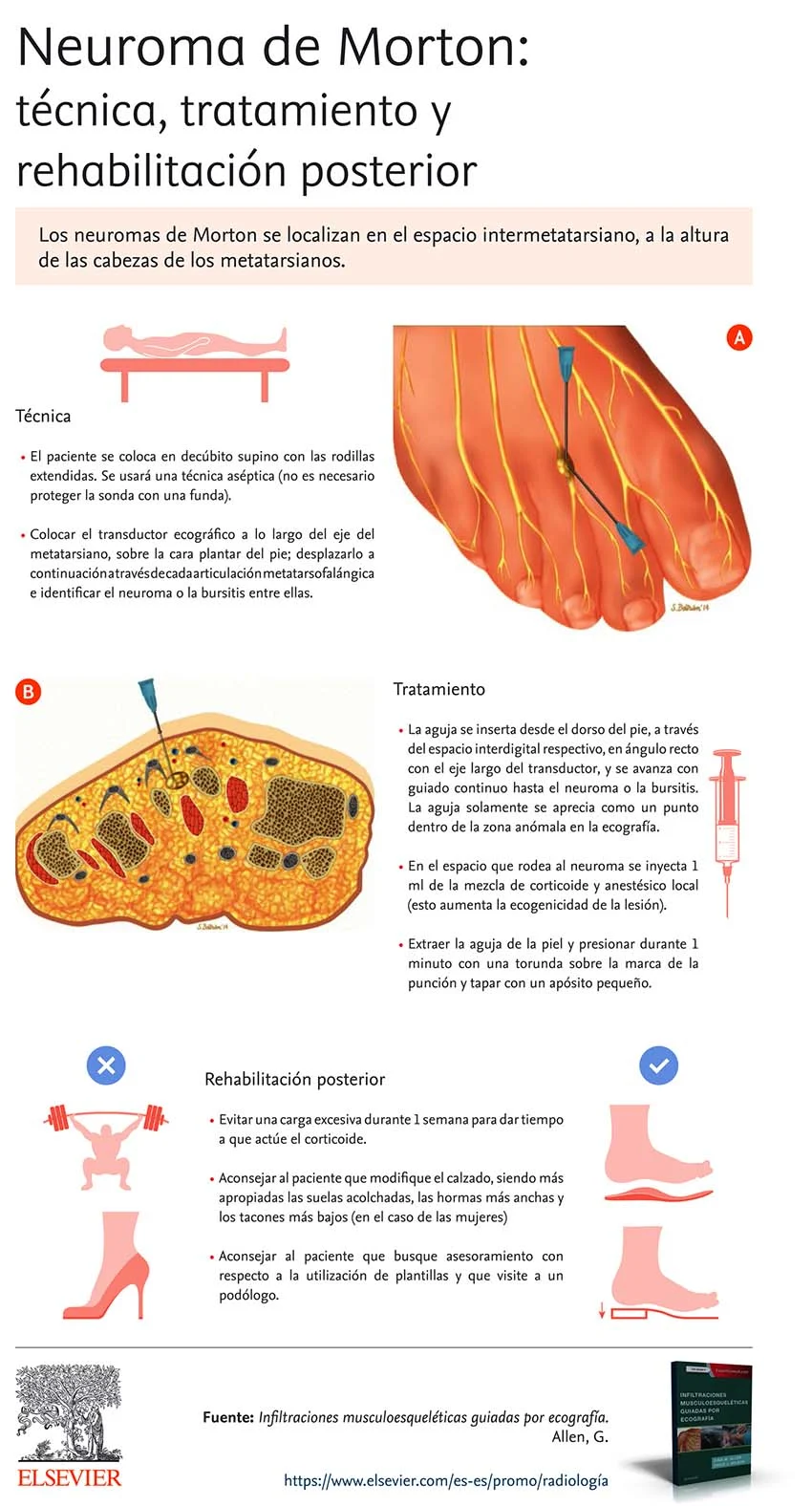 Neuroma de Morton: técnica, tratamiento y rehabilitación posterior