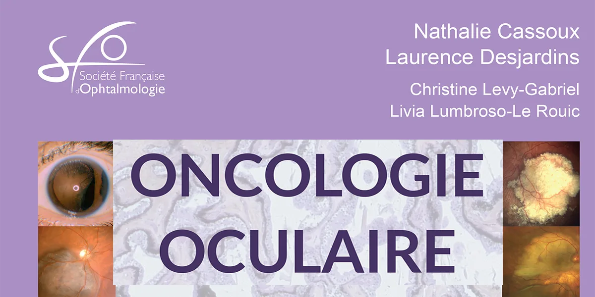 "Nævus oculaire : tumeur fréquente avec architecture limitée et ...