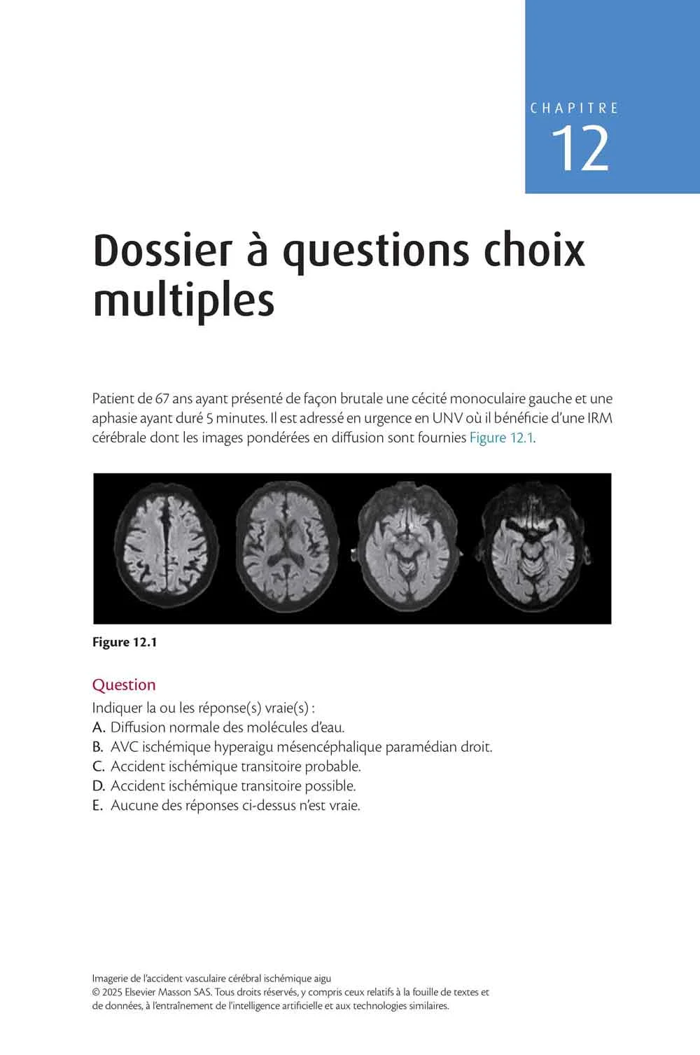 Imagerie de l'accident vasculaire cérébral ischémique aigu. AVC.