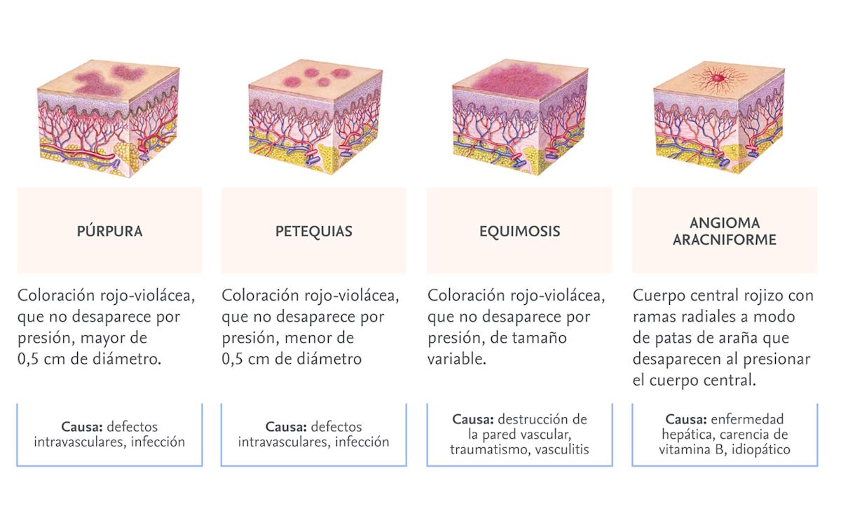 Examen de la piel. Púrpuras, 7 tipos de lesiones y sus causas