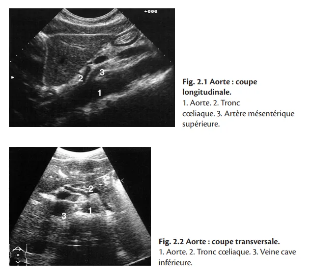 Gros vaisseaux de l'abdomen : échographie