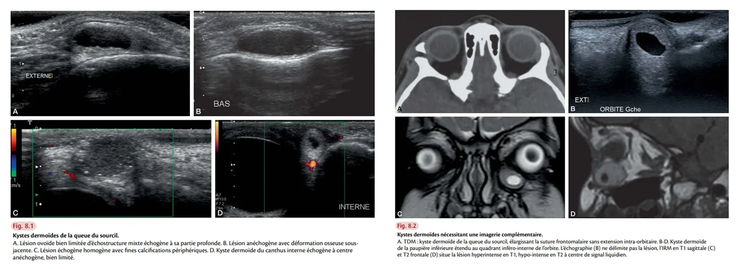 Tumeurs orbitaires de l’enfant