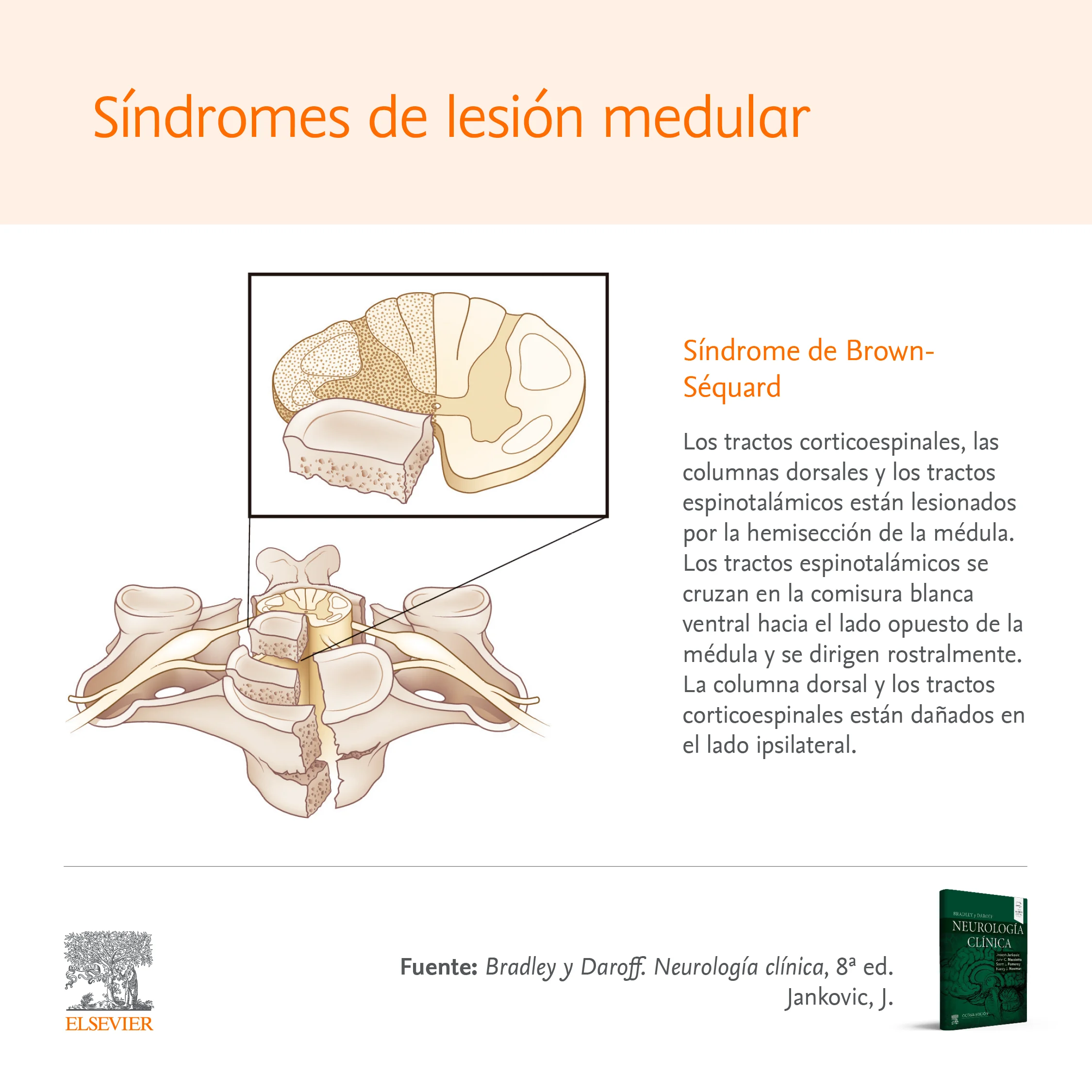 Lesiones Medulares: Patrones y Gravedad.