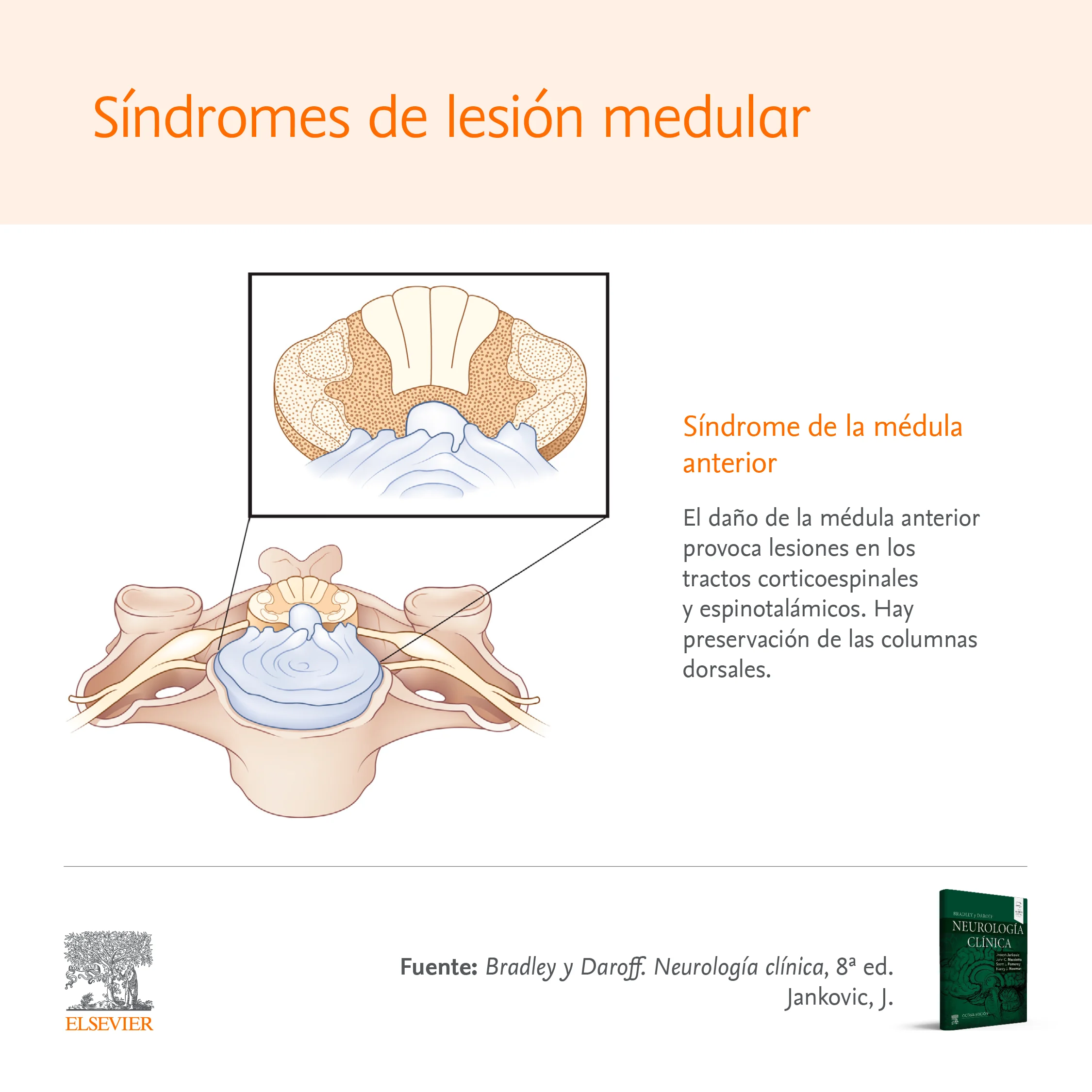 Lesiones Medulares: Patrones y Gravedad.