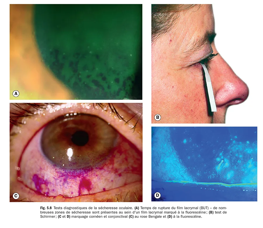 Gestion de la sécheresse oculaire : recommandations thérapeutiques ...