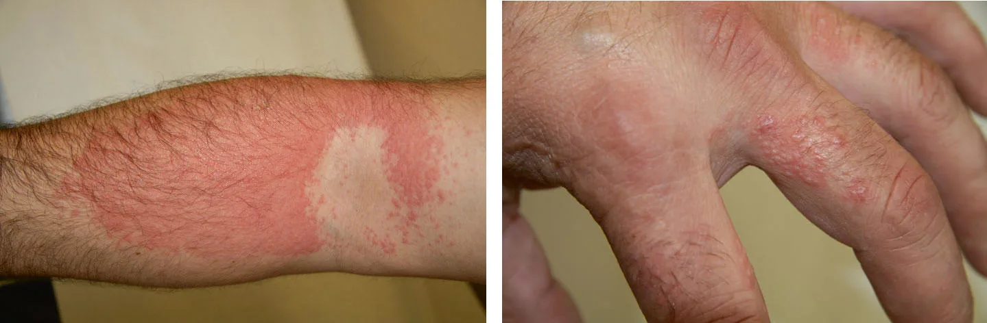 Fiches de dermatologie aux EDN : Item 116 Prurit