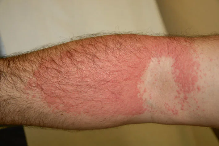 Fiches de dermatologie aux EDN : Item 116 Prurit