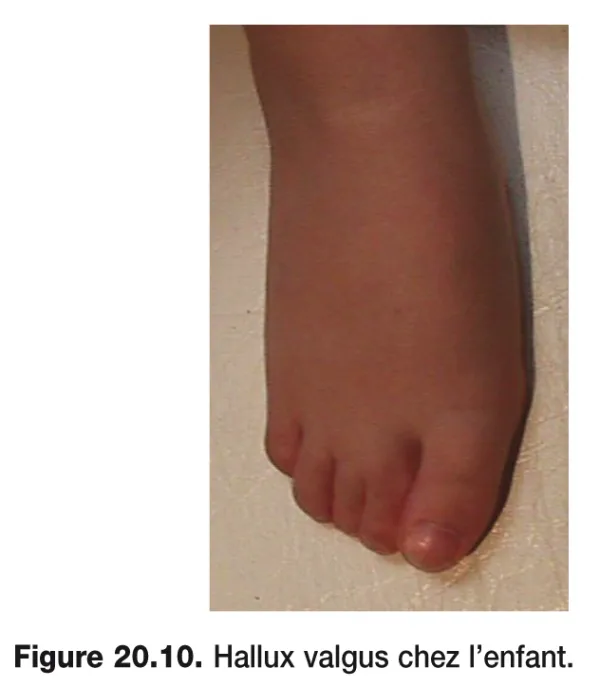 Chirurgie de l’hallux valgus chez l’enfant