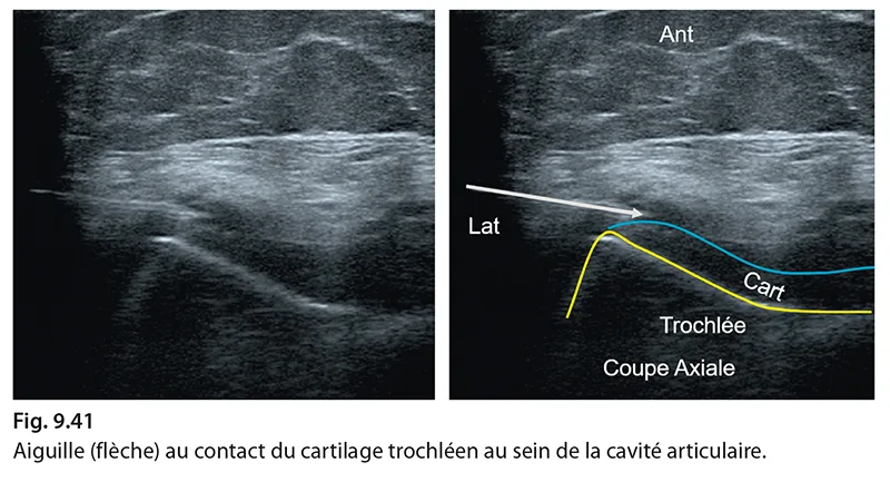 Infiltrations Échoguidées