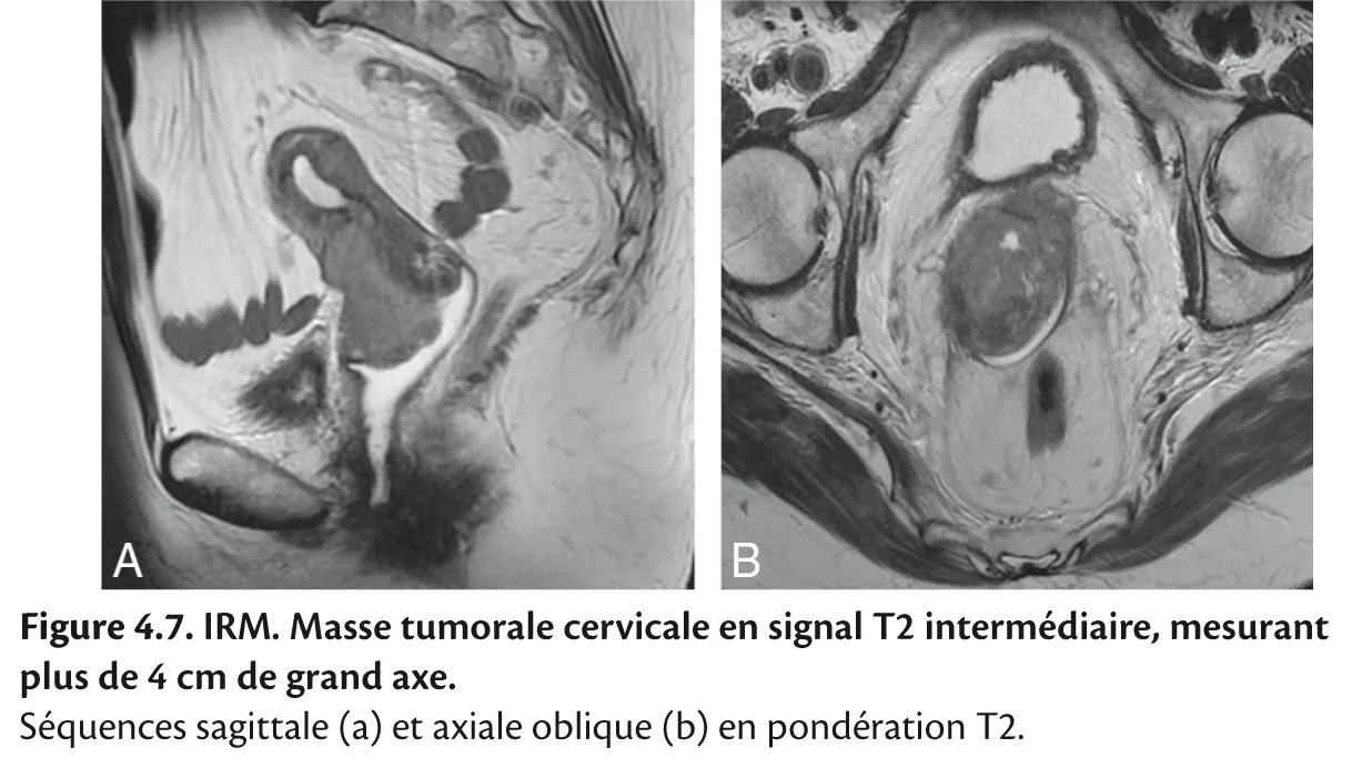 Pathologie du col utérin