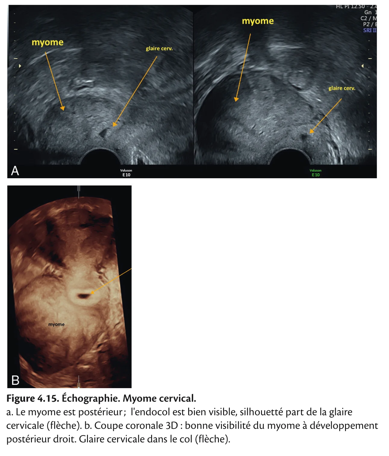 Pathologie du col utérin